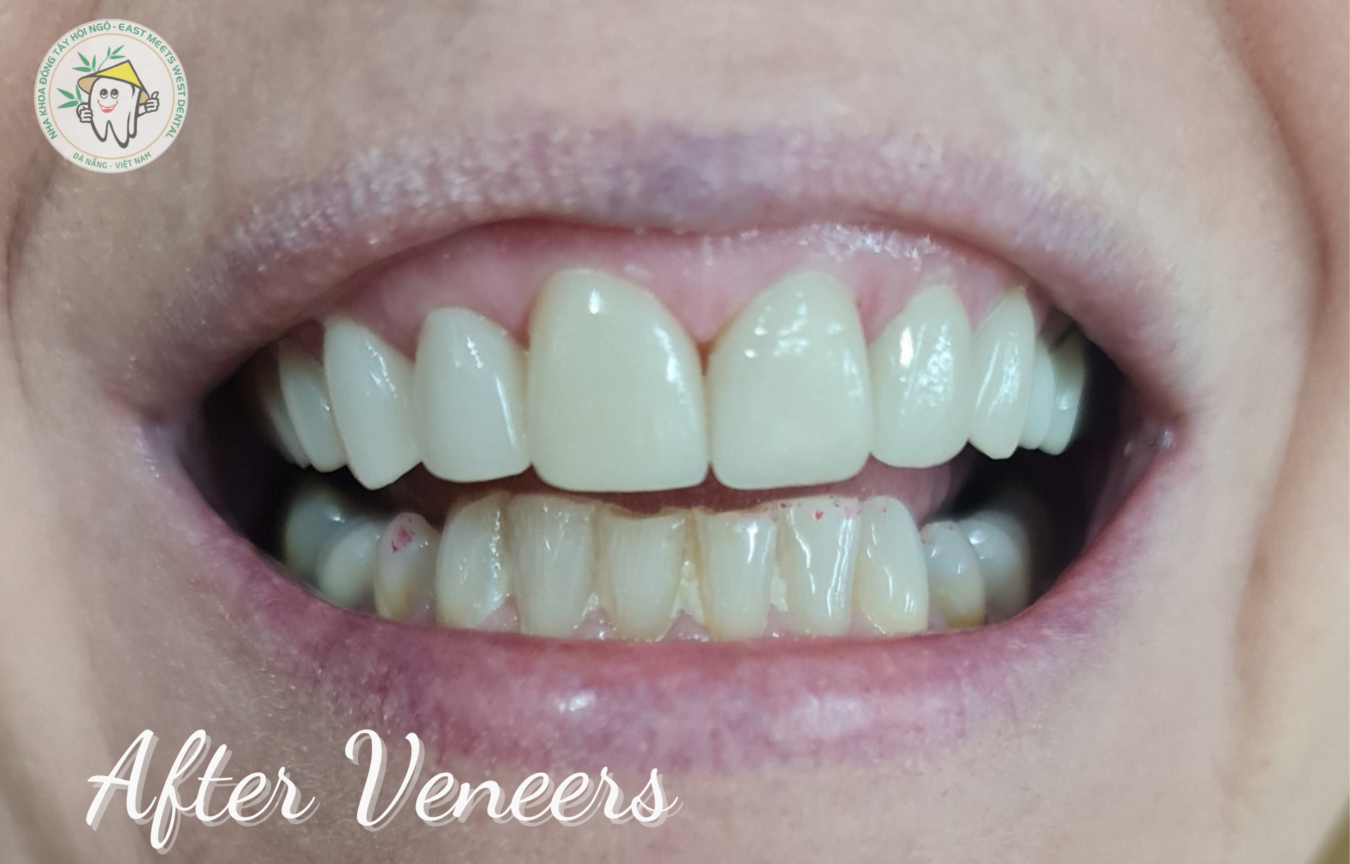 Porcelain Veneers in Da Nang you should know - East Meets West Dental